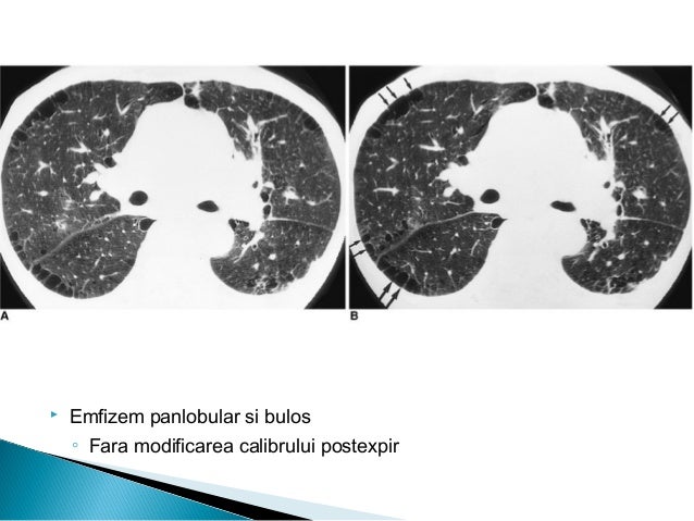 Semne in imagistica toracica ct