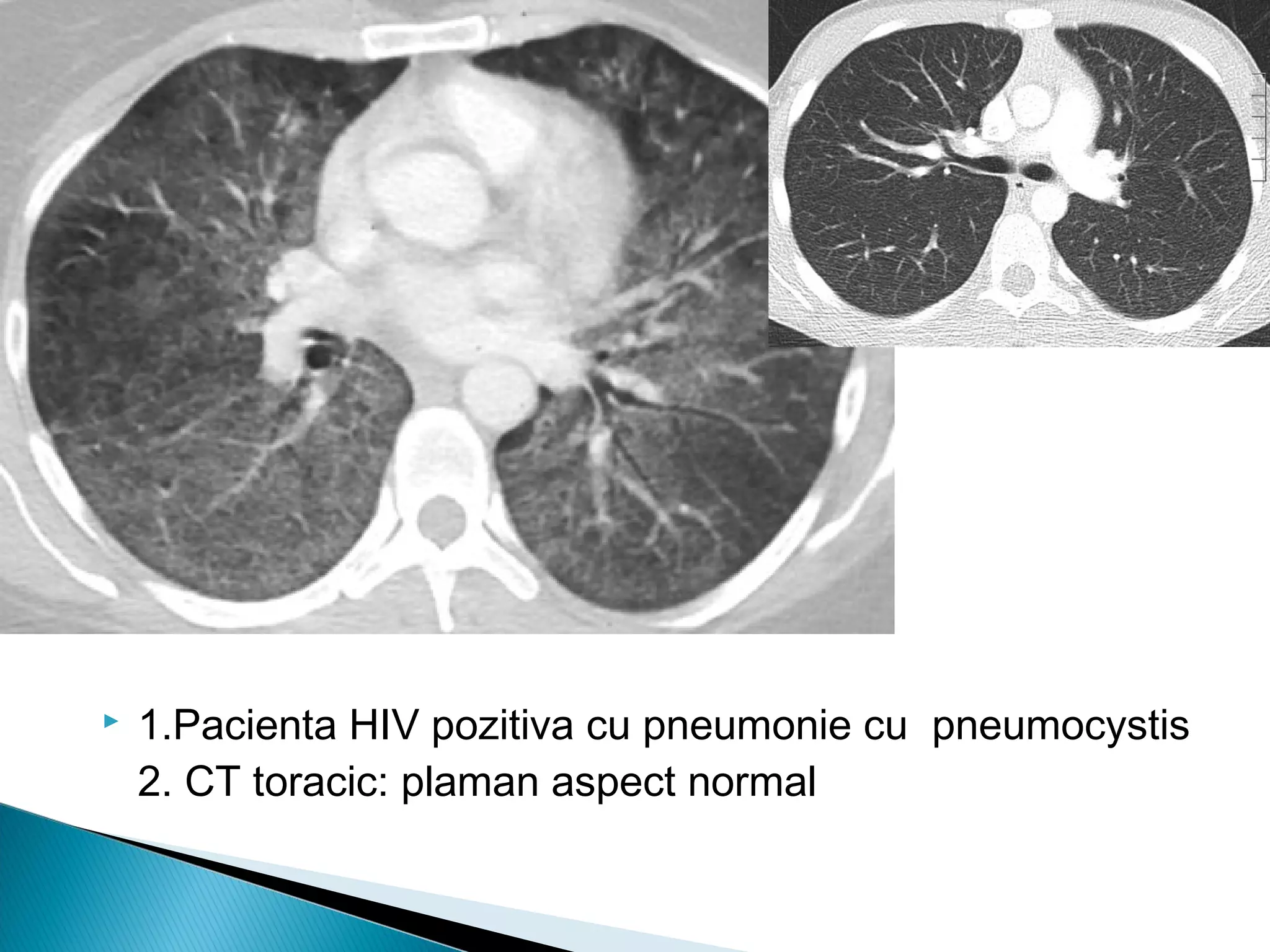 Semne in imagistica toracica ct | PPT
