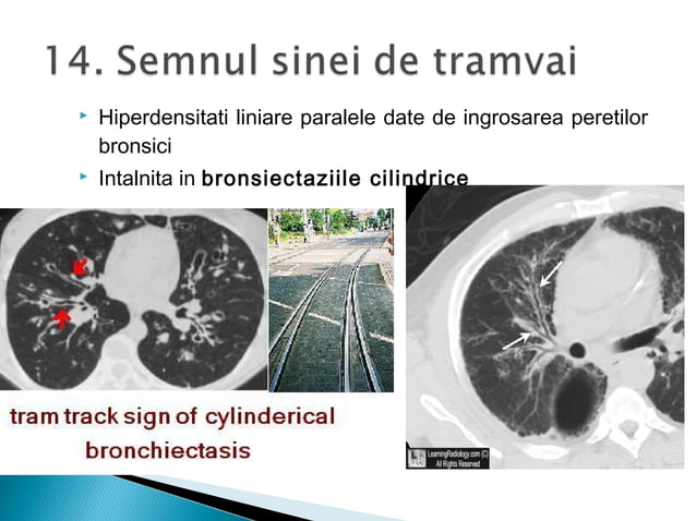 Semne in imagistica toracica ct | PPT