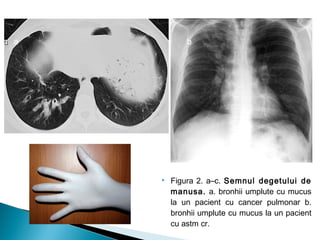 Semne in imagistica toracica ct | PPT