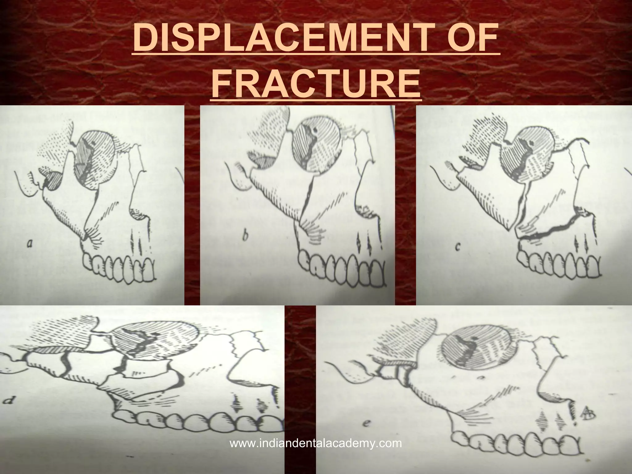 ZYGOMATIC COMPLEX FRACTURE | PPT