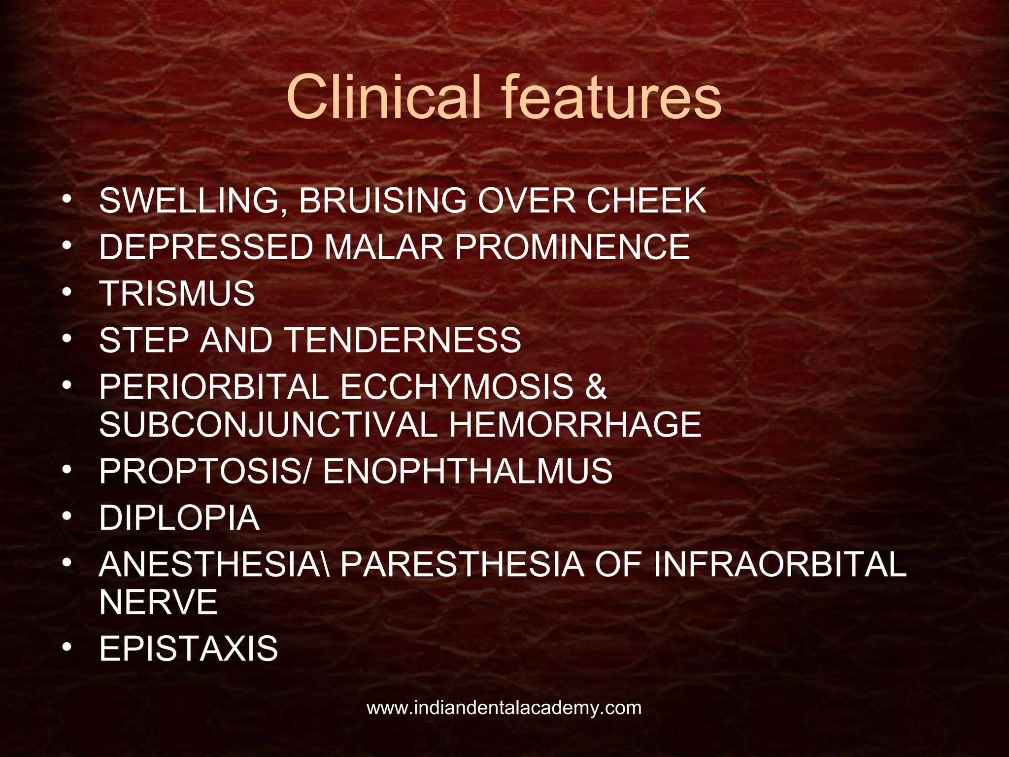 ZYGOMATIC COMPLEX FRACTURE | PPT