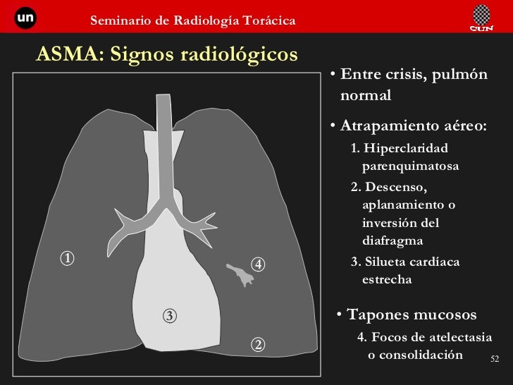 Radiología del tórax 2