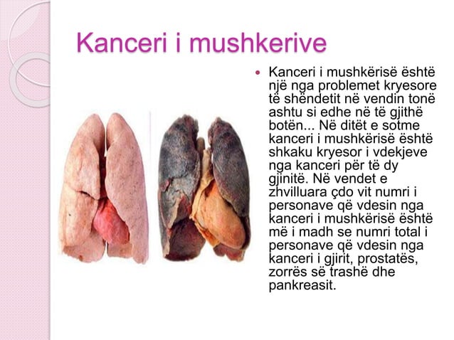 Semundjet kanceri | PPT