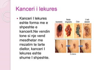Semundjet kanceri | PPTX