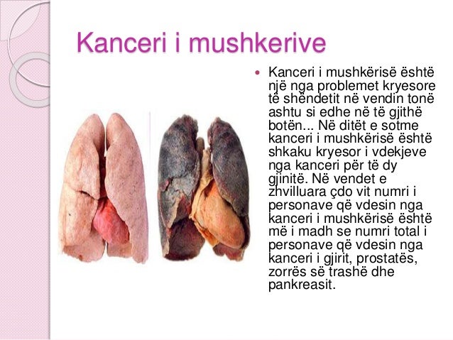 Semundjet kanceri