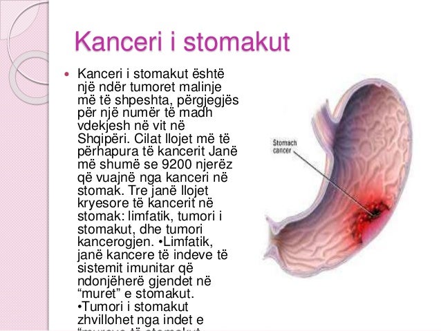 Semundjet kanceri