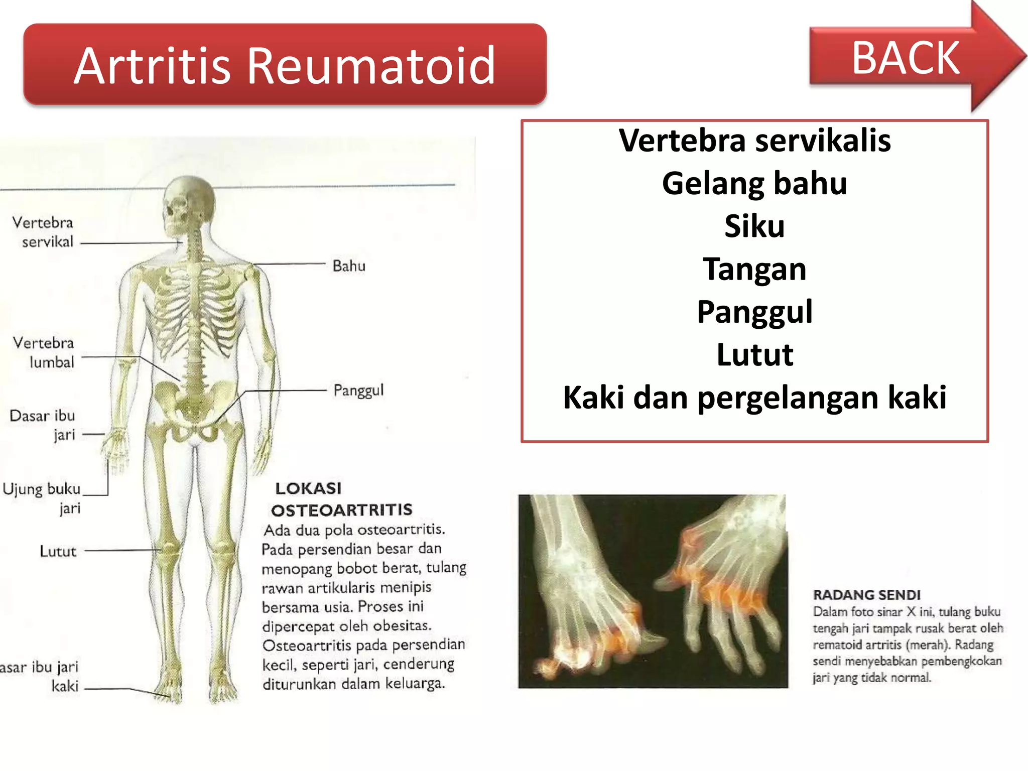Sendi sendi yang terkait dengan penyakit nyeri | PPTX
