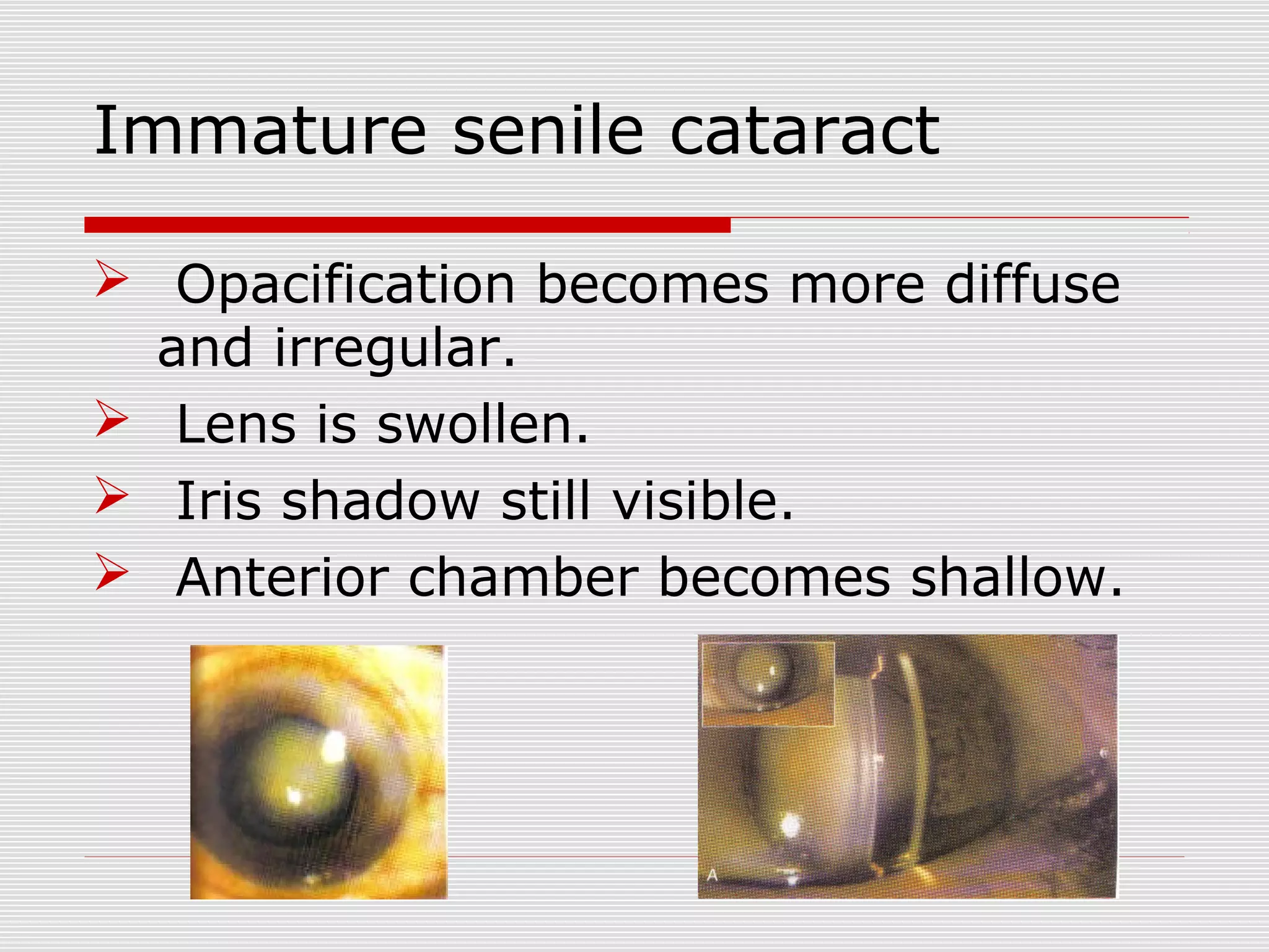 Senile Cataract | PPT
