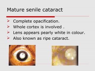 Senile Cataract | PPT