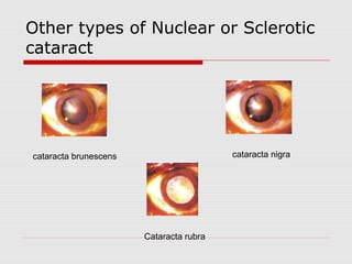 Immature Senile Cataract