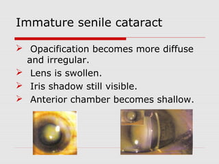 Mechanisms Of Senile Cataract Formation – MIIKME