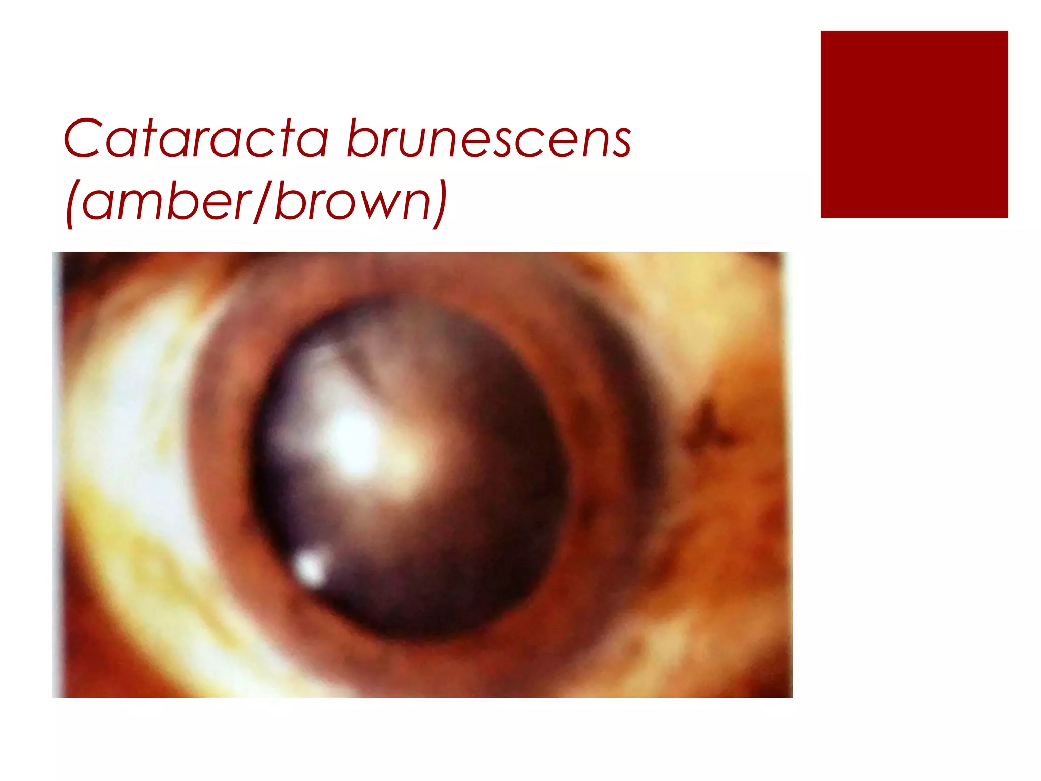 Senile cataract | PPT