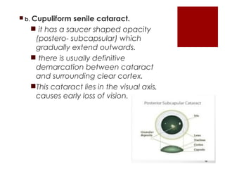 Senile cataract | PPT