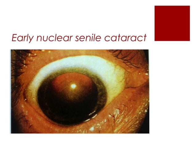 Senile cataract | PPT