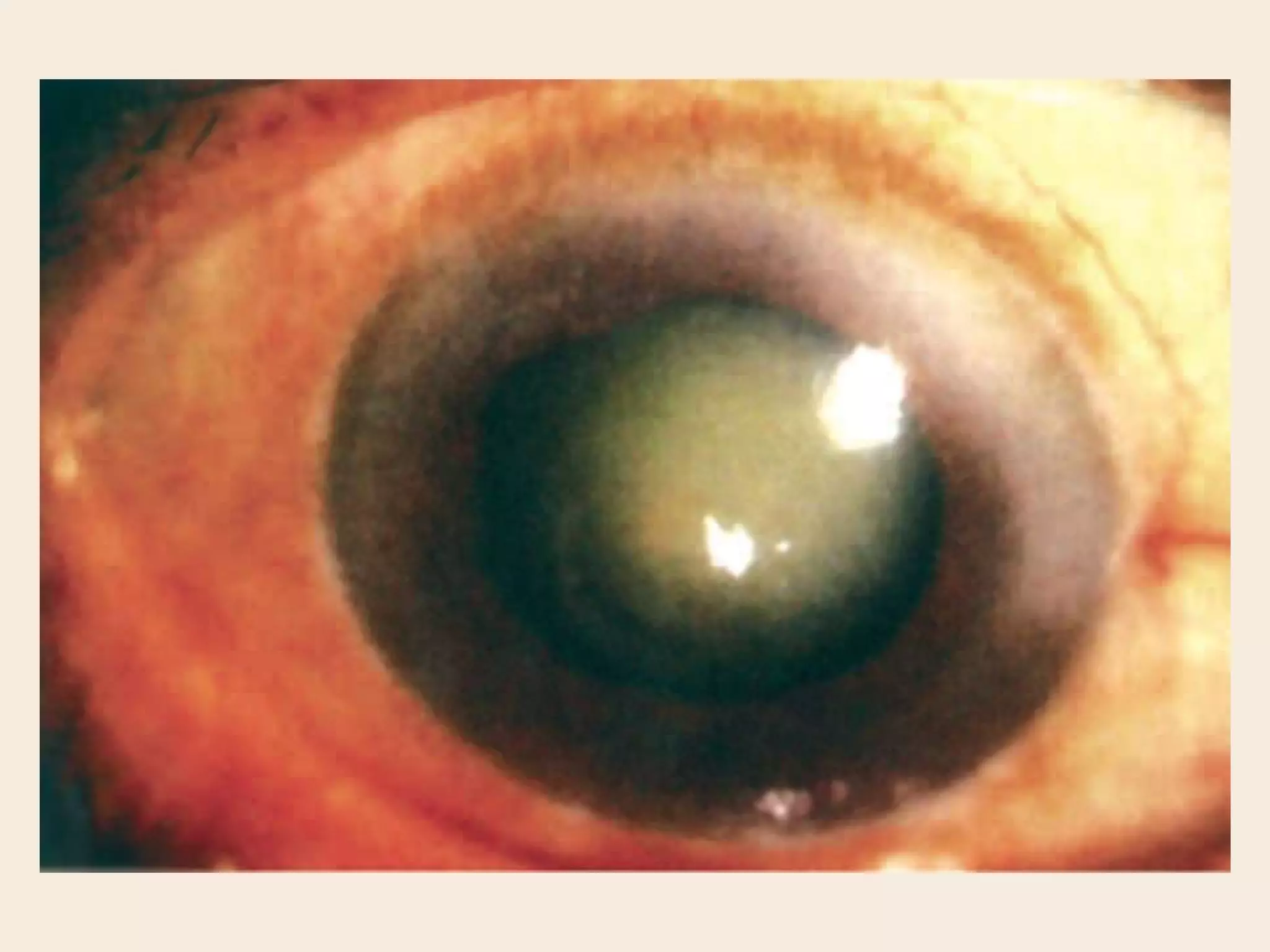 Senile cataract quick revision ( ophthalmology ) | PPTX