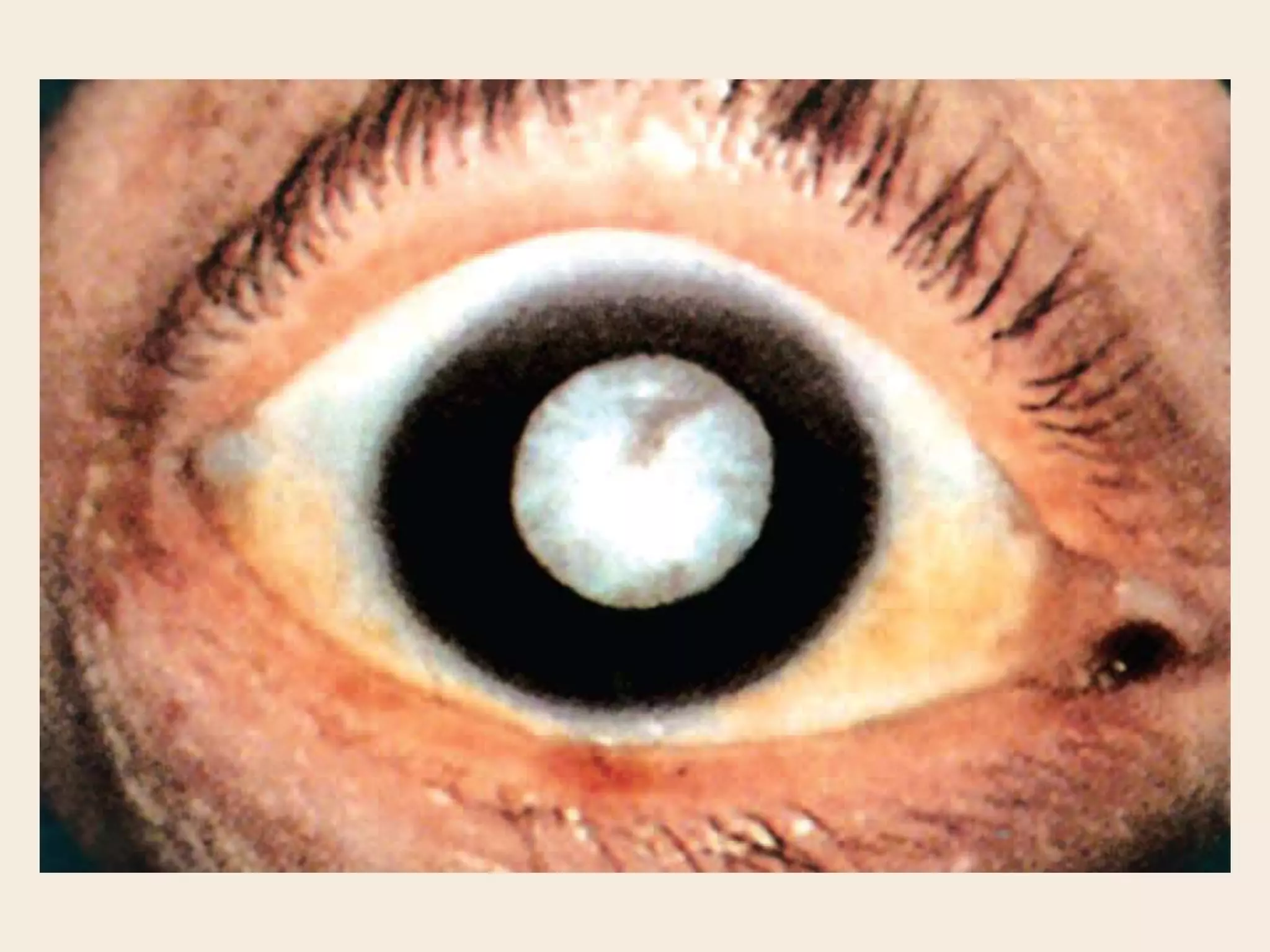 Senile cataract quick revision ( ophthalmology ) | PPTX
