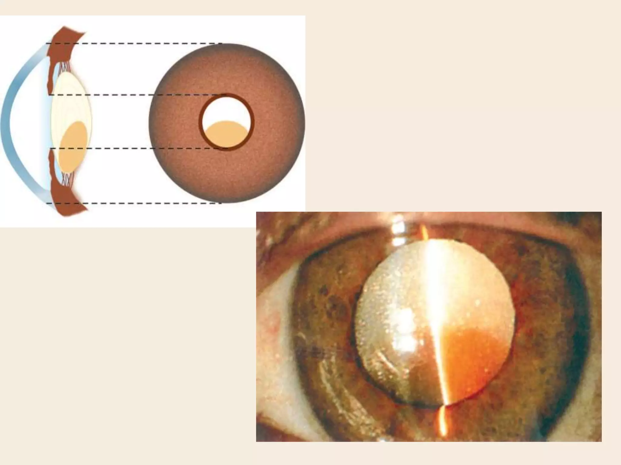Senile cataract quick revision ( ophthalmology ) | PPTX