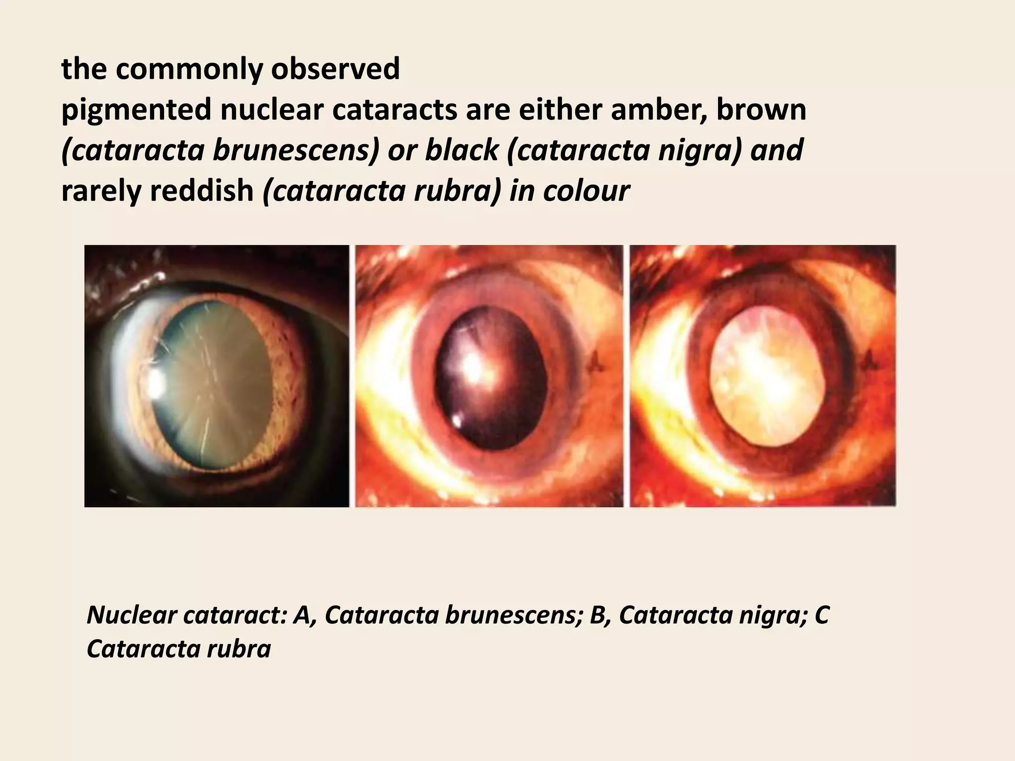 Senile Cataract Quick Revision Ophthalmology PPTX Senile Cataract Quick Revision Ophthalmology PPTX