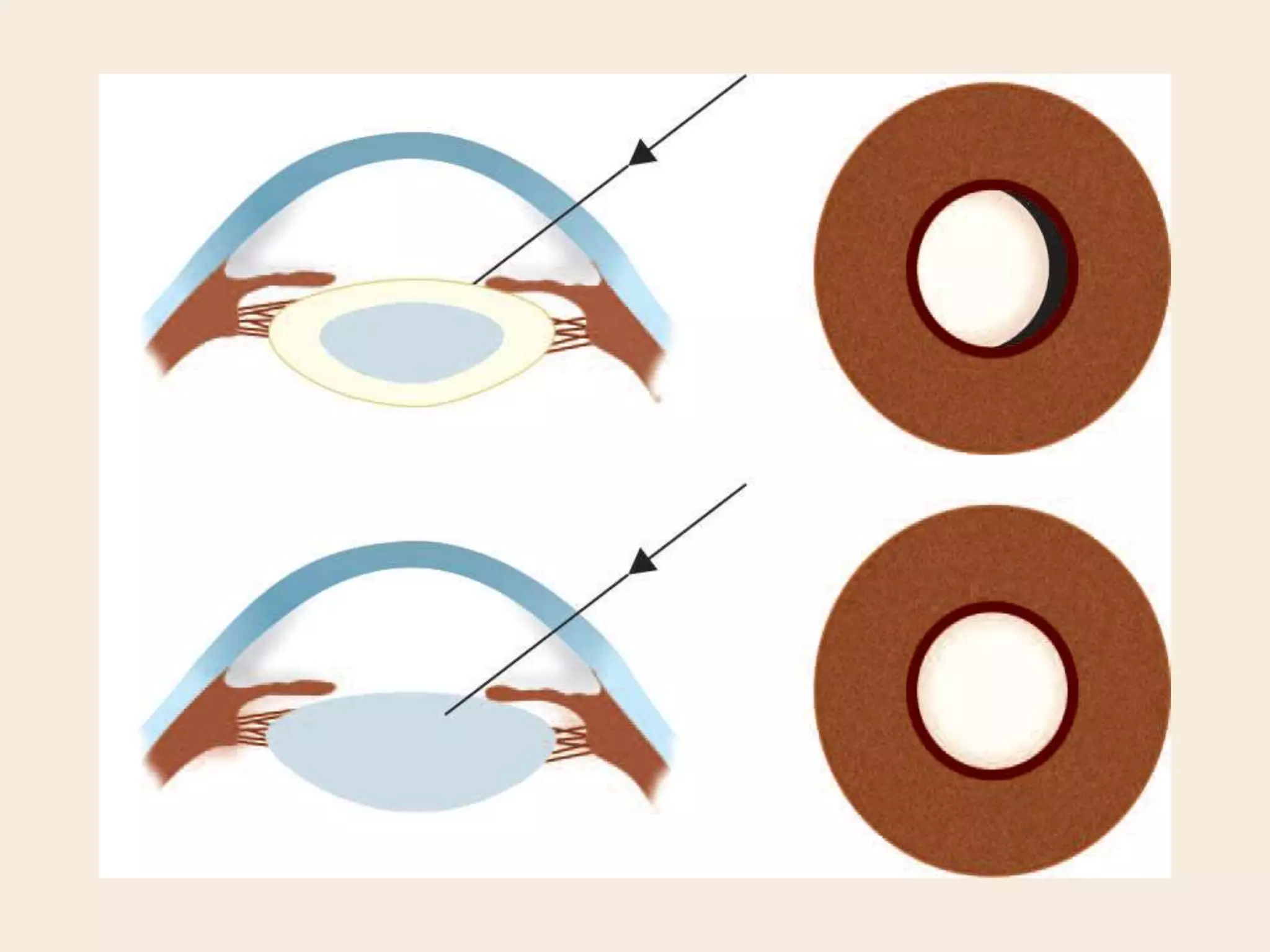 Senile cataract quick revision ( ophthalmology ) | PPTX