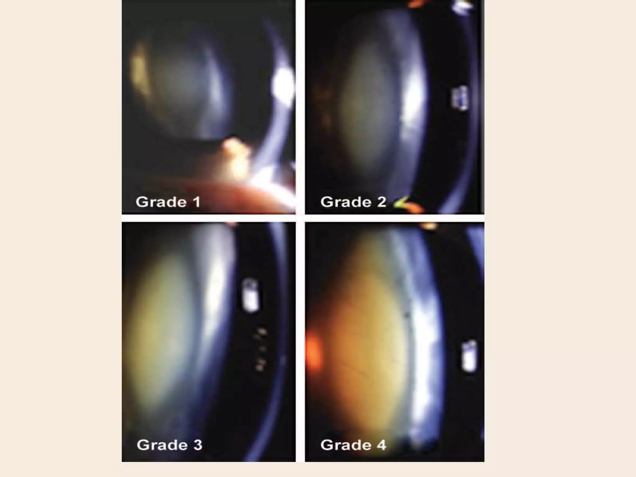 Senile cataract quick revision ( ophthalmology ) | PPTX