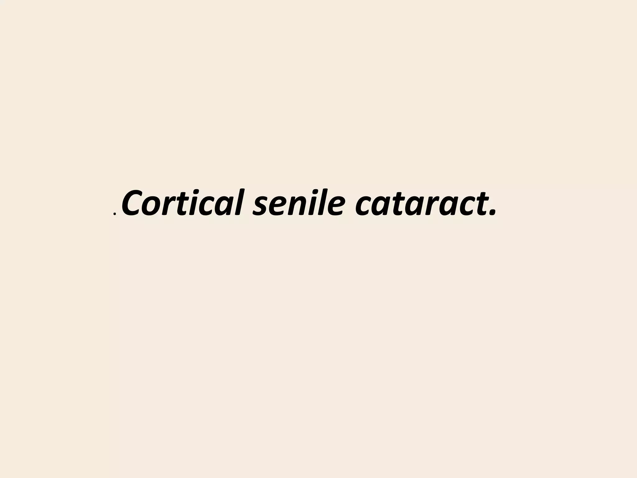 Senile cataract quick revision ( ophthalmology ) | PPTX
