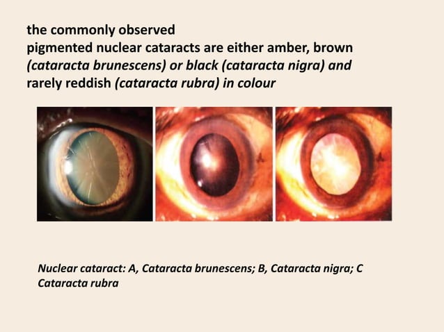 Senile cataract quick revision ( ophthalmology ) | PPTX