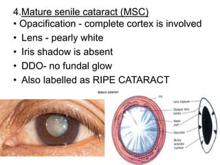 senile cataract.pptx