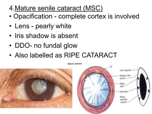 senile cataract.pptx | Eye and Vision Conditions | Diseases and Conditions