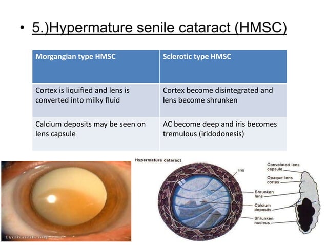 senile cataract.pptx | Eye and Vision Conditions | Diseases and Conditions
