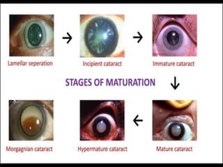 senile cataract.pptx