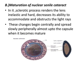 senile cataract.pptx