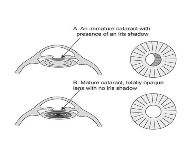 senile cataract.pptx | Eye and Vision Conditions | Diseases and Conditions