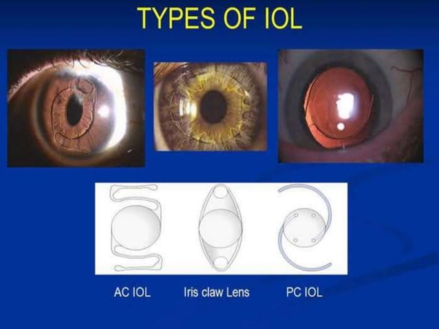 senile cataract.pptx | Eye and Vision Conditions | Diseases and Conditions