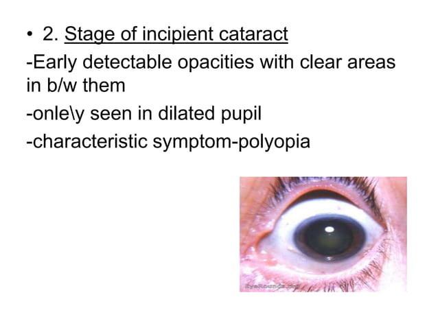 senile cataract.pptx | Eye and Vision Conditions | Diseases and Conditions