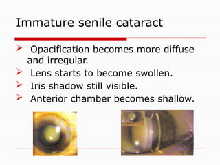 Senile Cataract Types of Cataract Lens.pptx