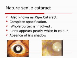 Senile Cataract Types of Cataract Lens.pptx
