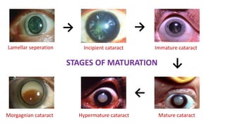 Senile cataract | PPTX