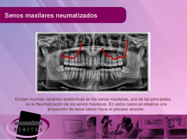 Senos maxilares neumatizados