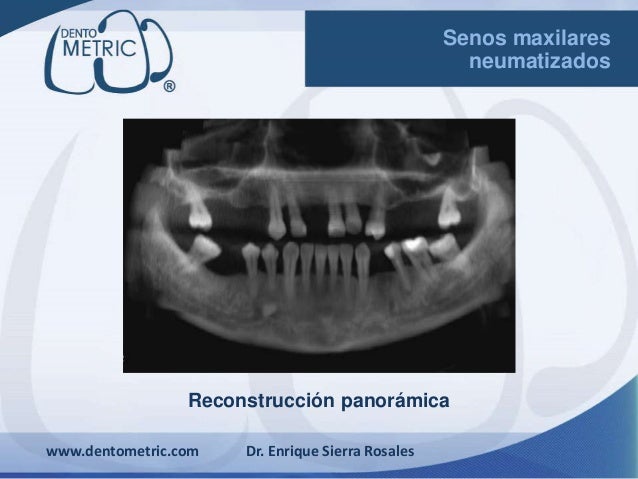 Senos maxilares neumatizados
