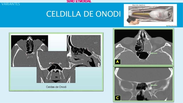 Senos paranasales orl