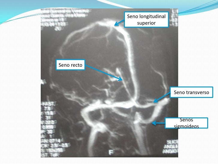 ANATOMIA DE LOS SENOS VENOSOS DE LA DURAMADRE