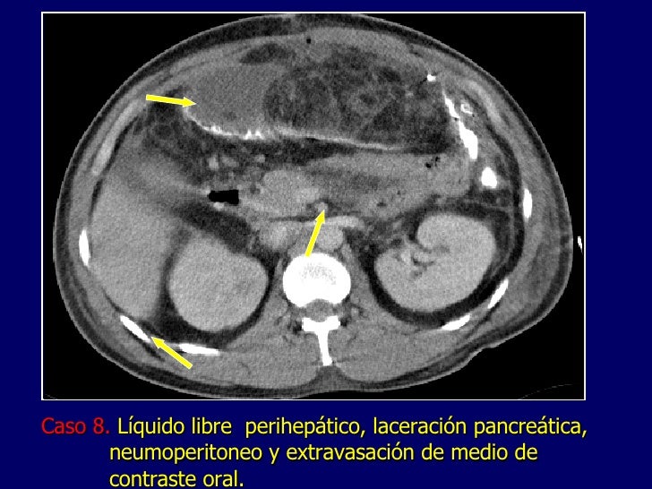 Sensibilidad Y Especificidad Del Ultrasonido Fast En La DeteccióN De…