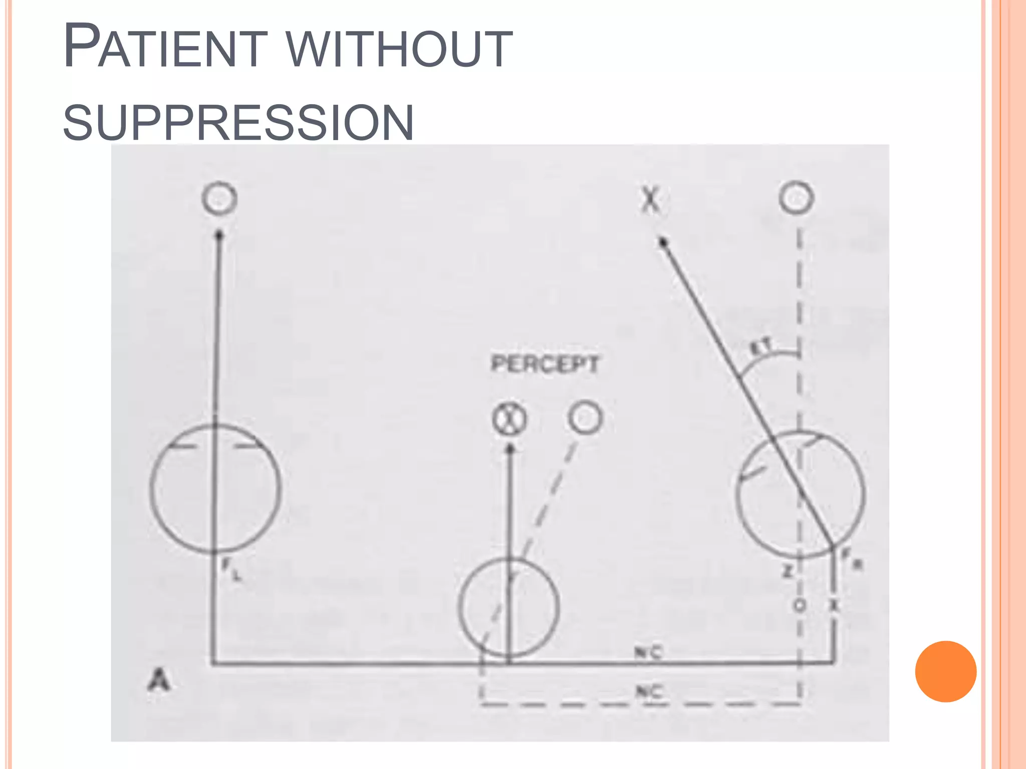 Sensory evaluation of squint | PPTX