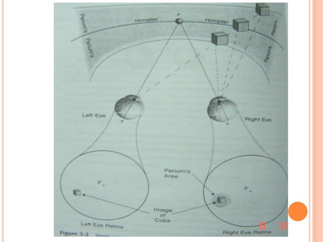 Sensory evaluation of squint | PPTX | Eye and Vision Conditions ...