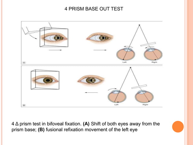 Sensory evaluation of squint | PPTX | Eye and Vision Conditions ...
