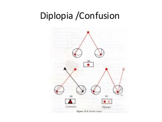 Sensory evaluation of strabismus | PPT