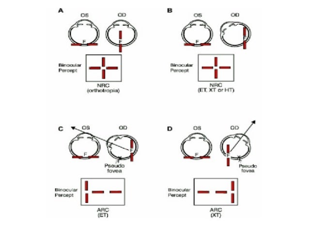 Sensory evaluation of strabismus | PPT