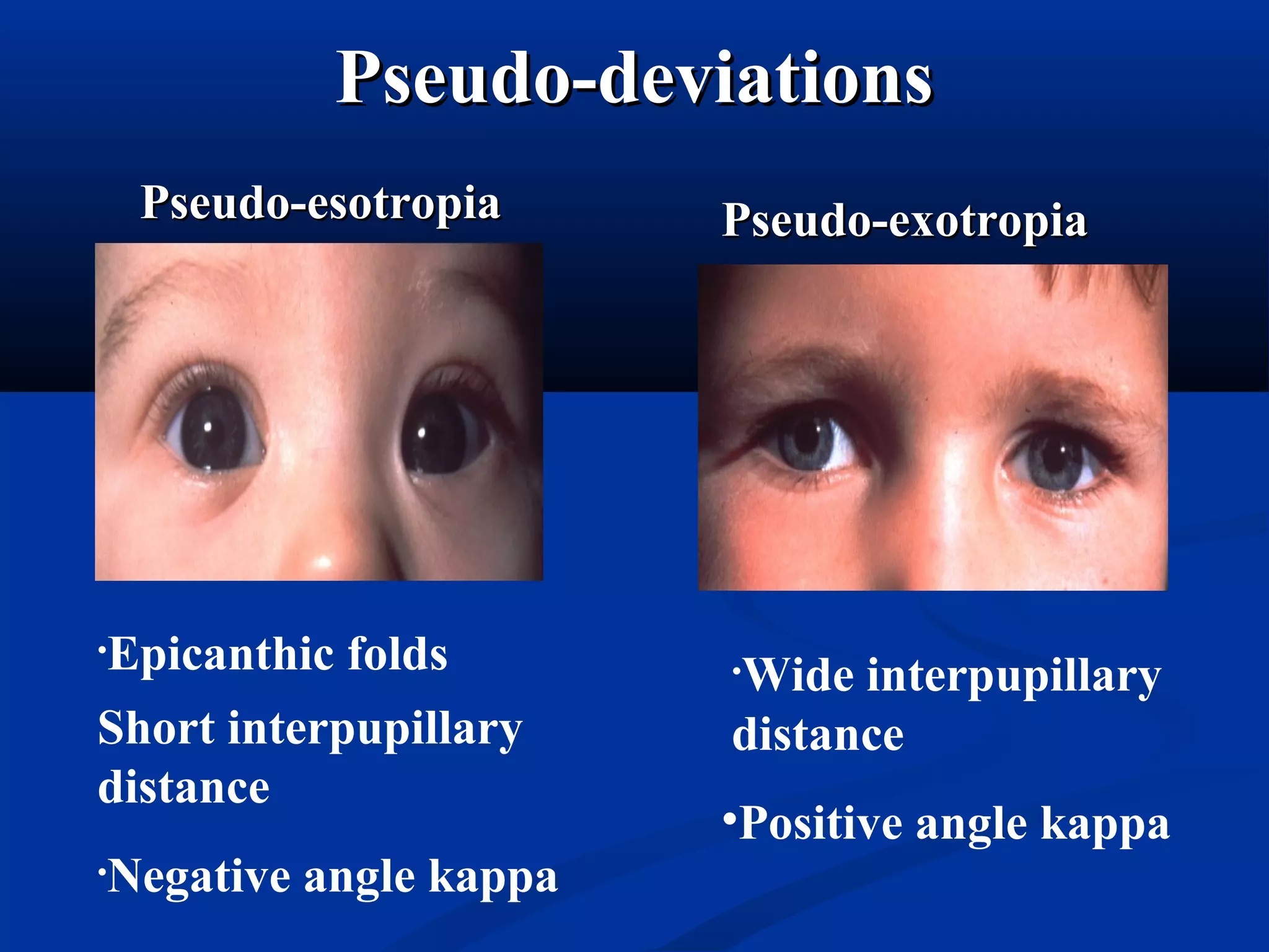 Sensory & motor evaluation of strabismus | PPT