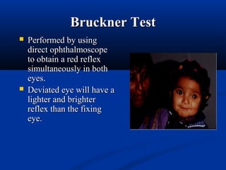 Sensory & motor evaluation of strabismus | PPT